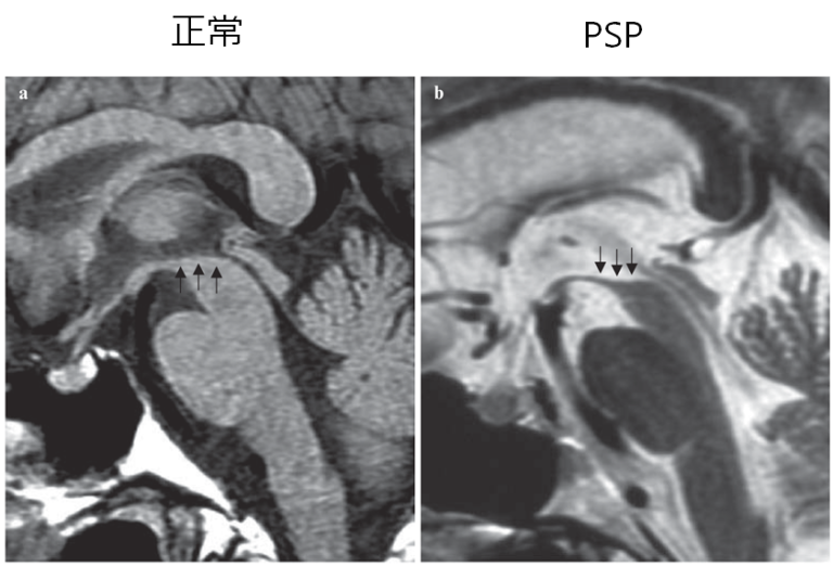 Cingulate sulcus sign - 医学事始 いがくことはじめ