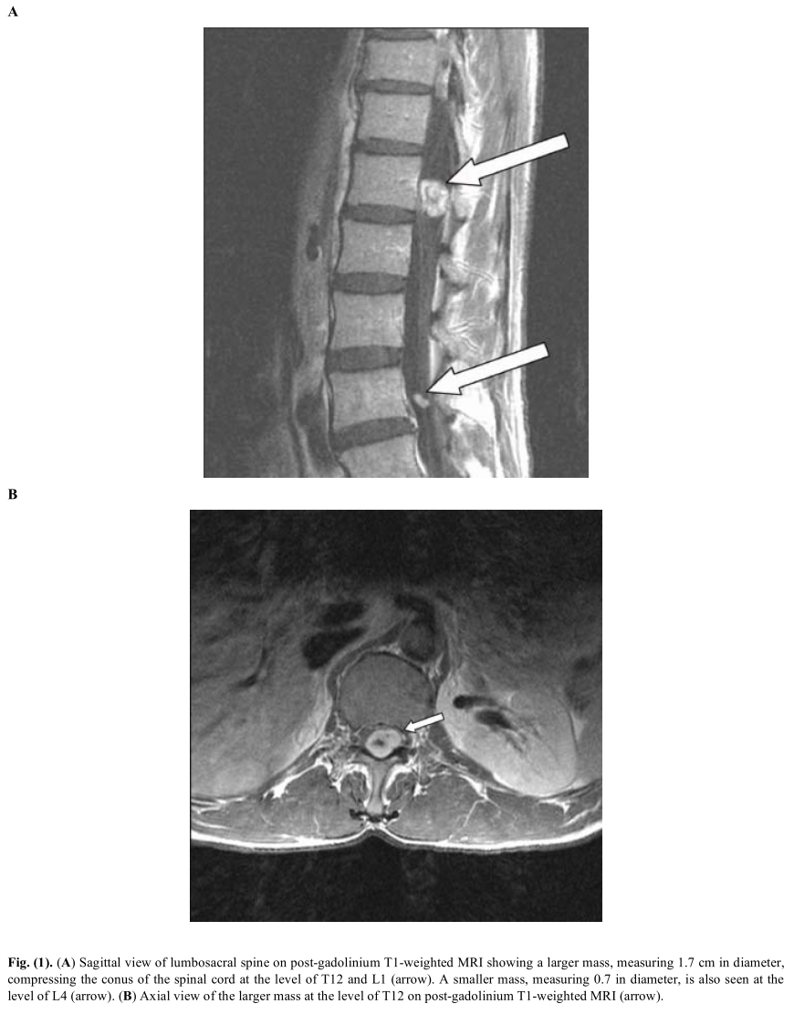 多発神経根症 polyradiculopathy - 医学事始 いがくことはじめ