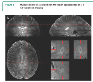 RIS: radiologically isolated syndrome - 医学事始 いがくことはじめ